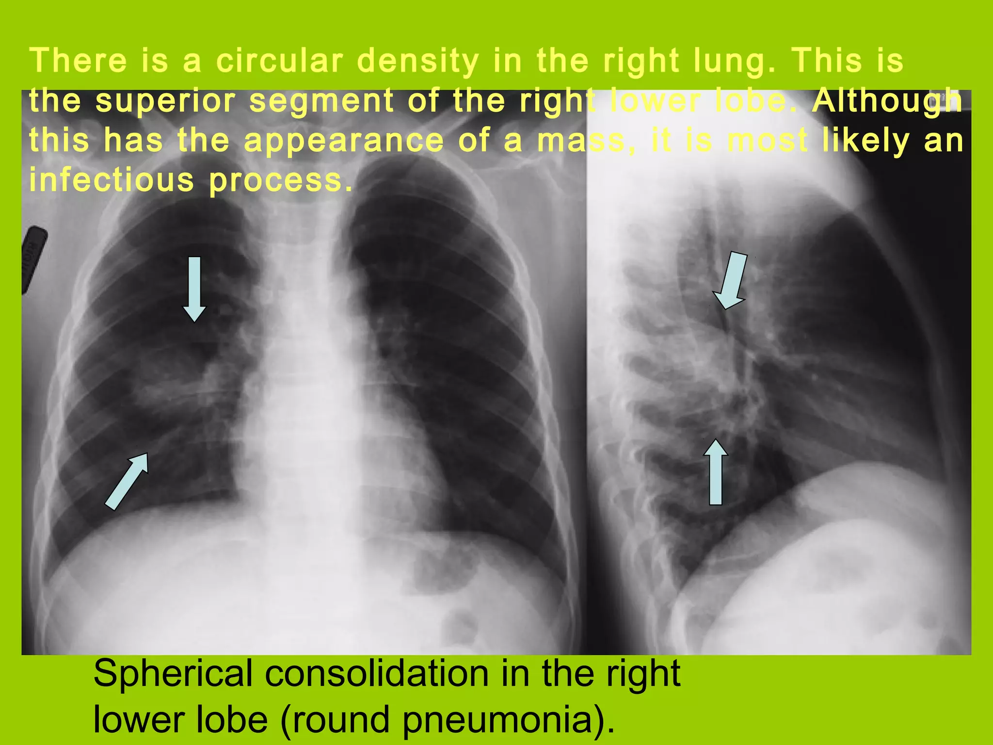 Pediatric radiology quizes chest and msk | PPT