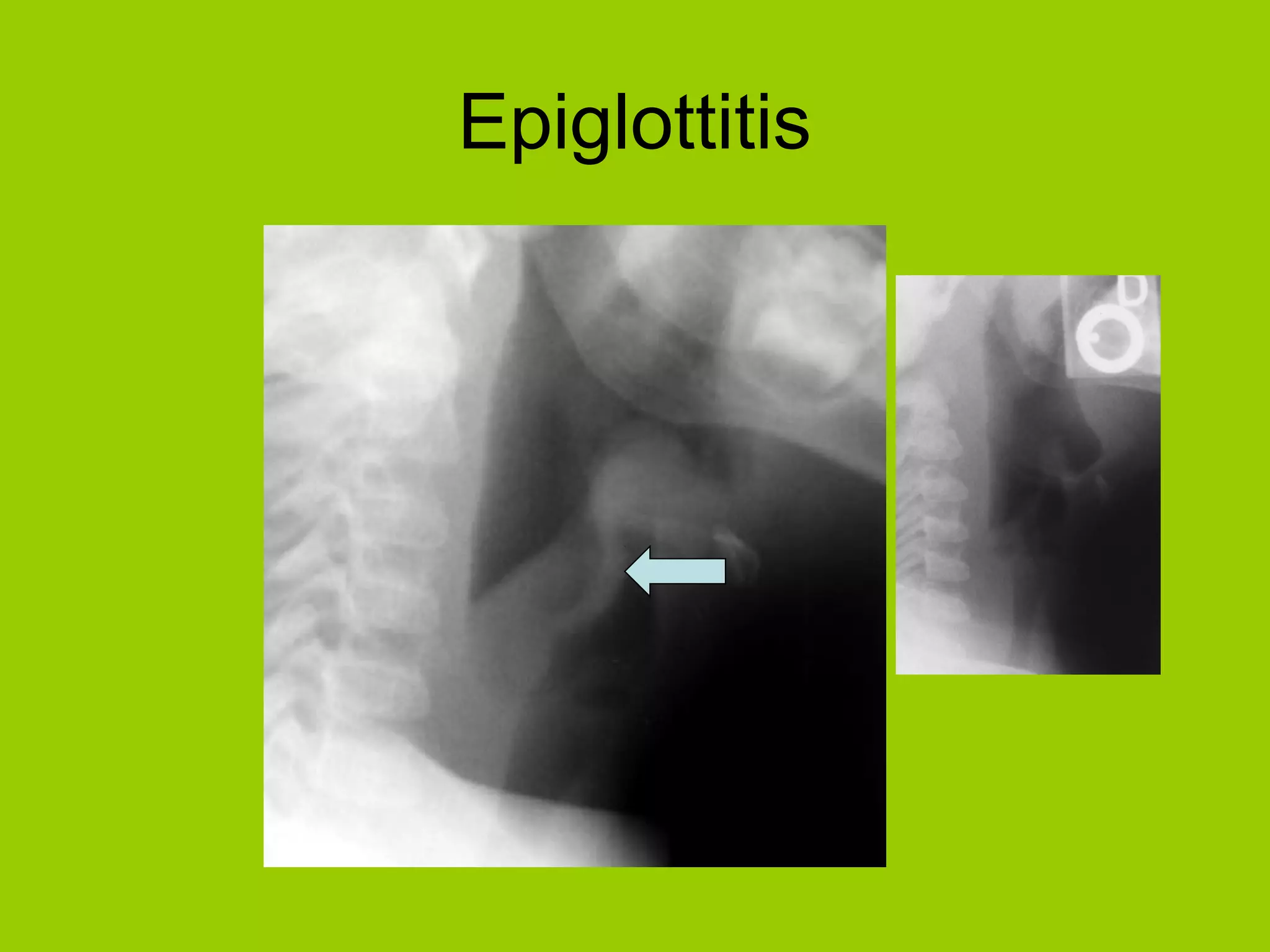 Pediatric radiology quizes chest and msk | PPT