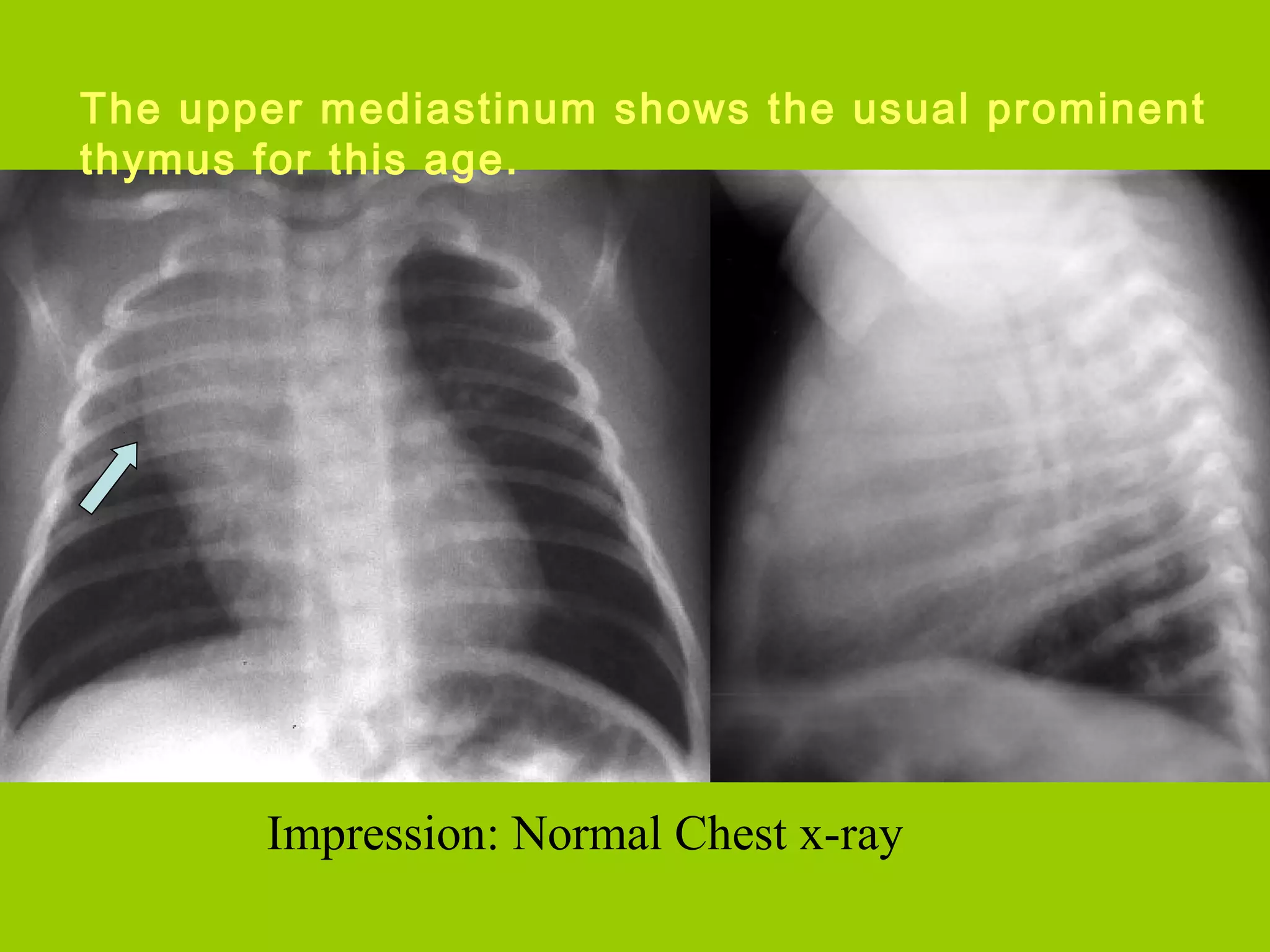 Pediatric radiology quizes chest and msk | PPT