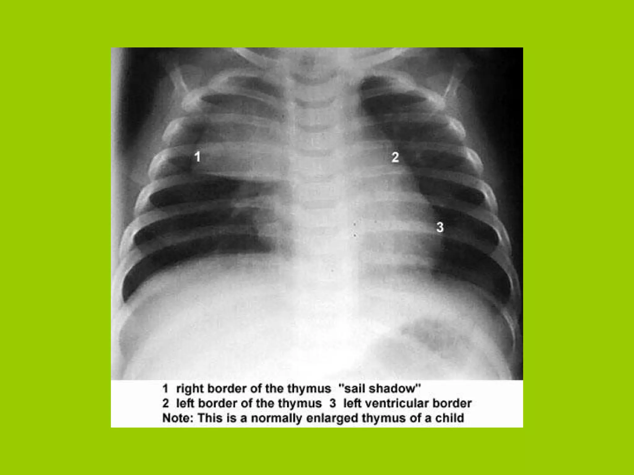 Pediatric radiology quizes chest and msk | PPT