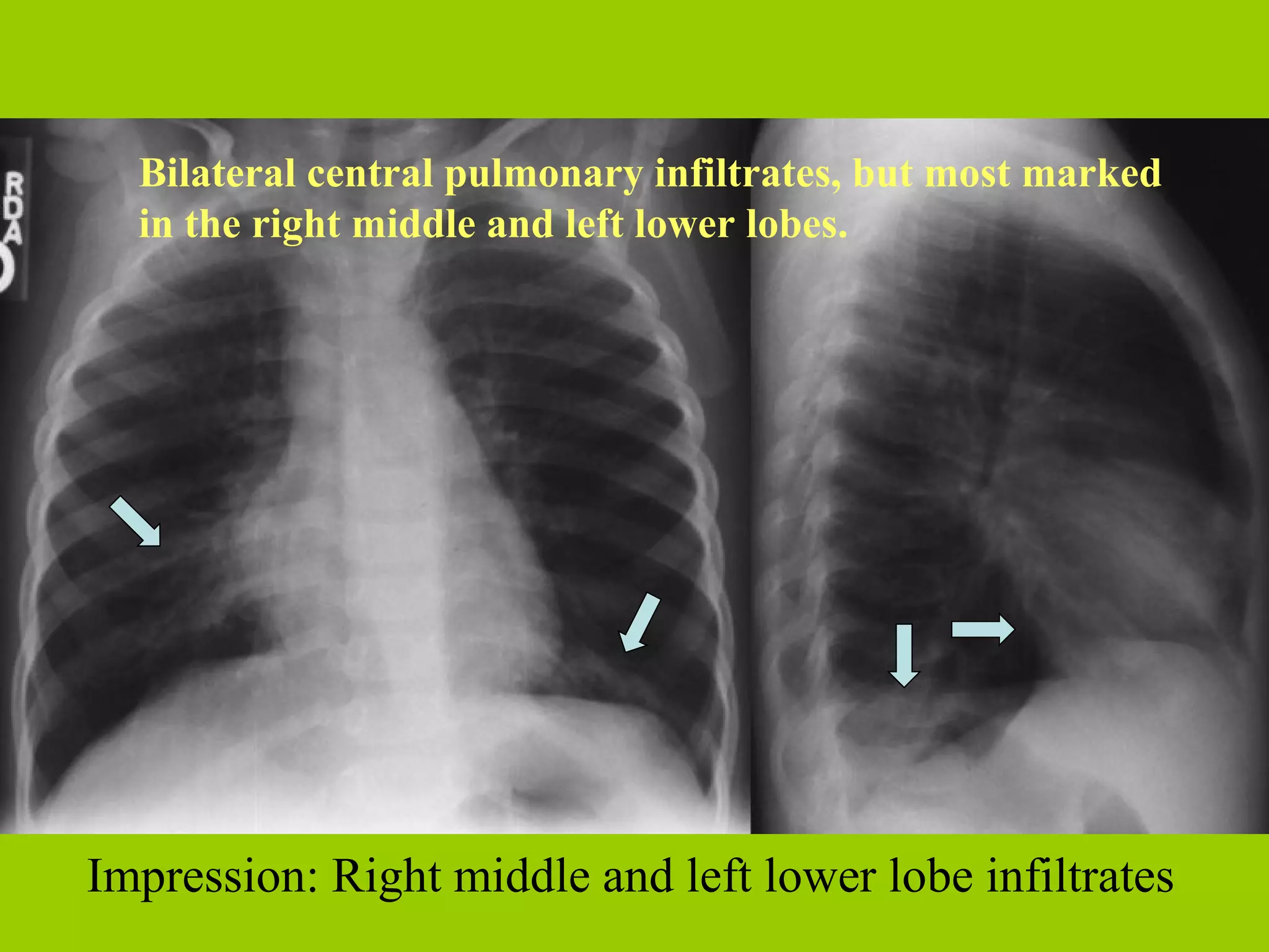 Pediatric radiology quizes chest and msk | PPT