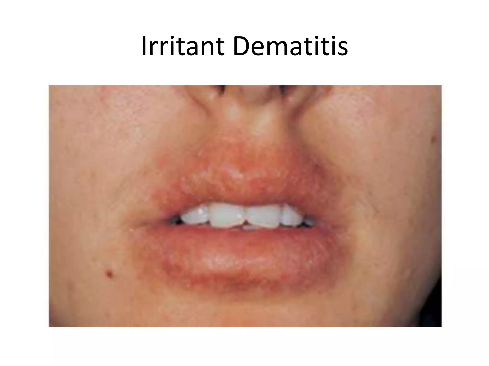 Pediatric rashes | PPTX