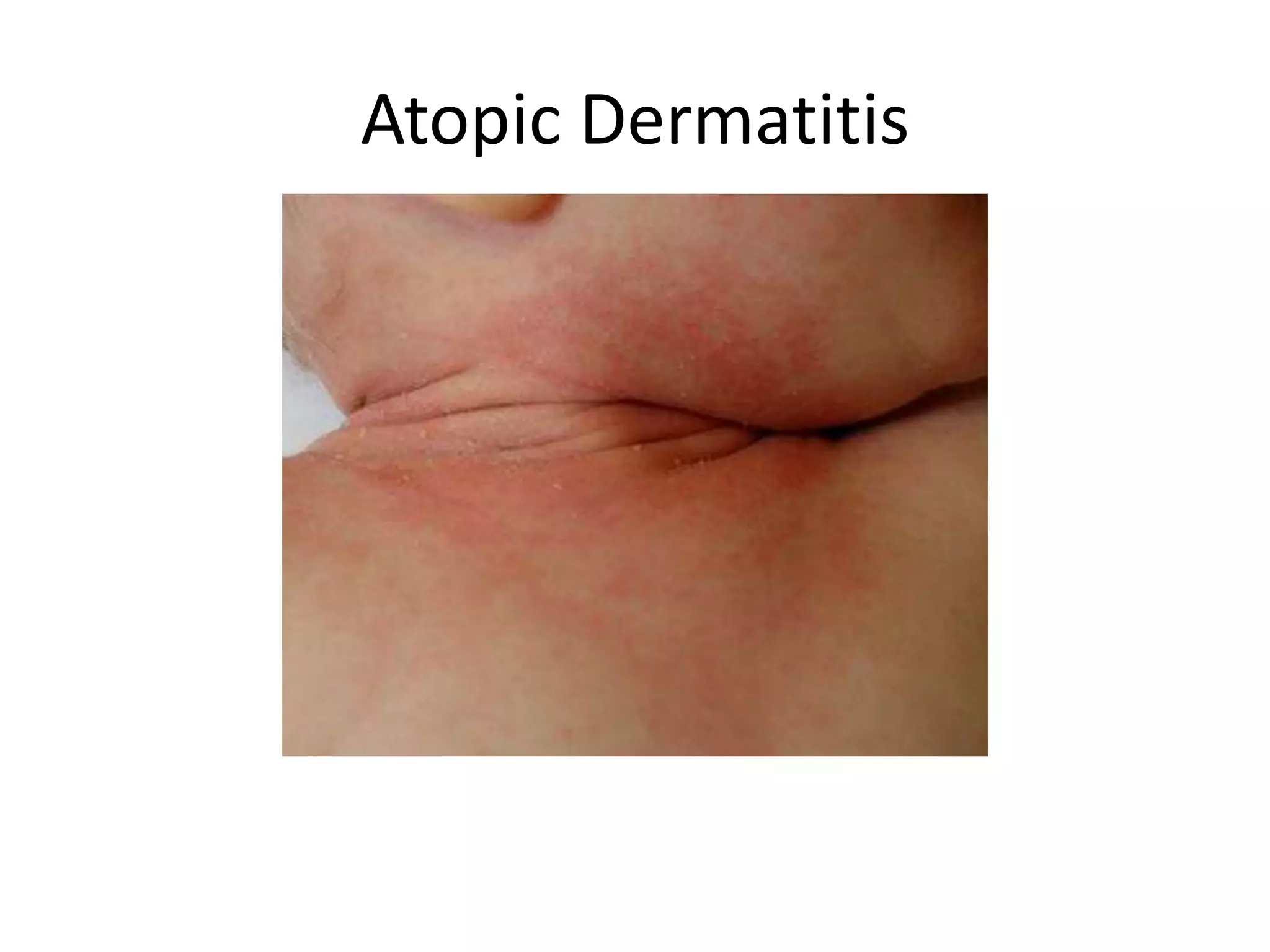 Pediatric rashes | PPTX