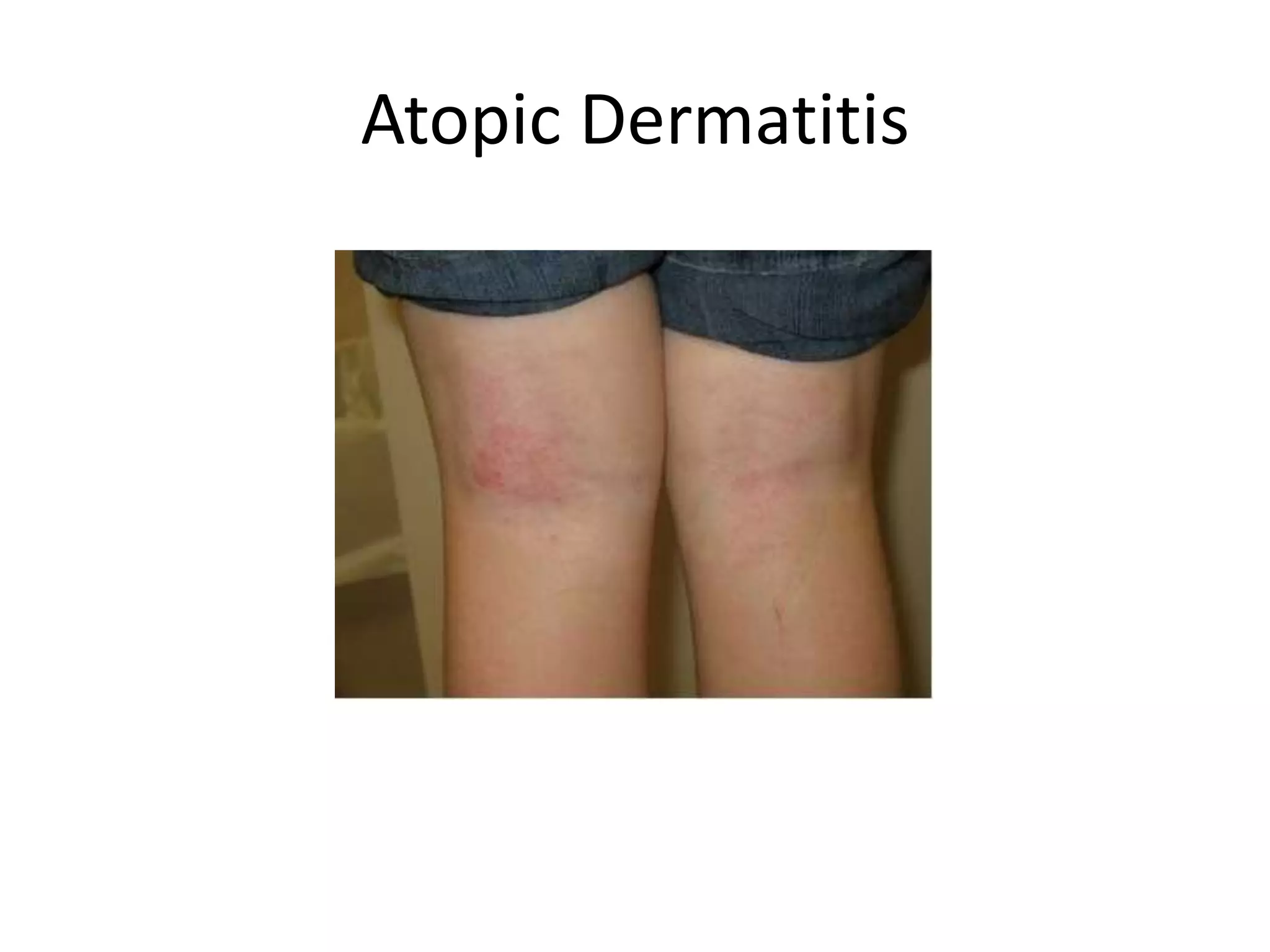 Pediatric rashes | PPTX