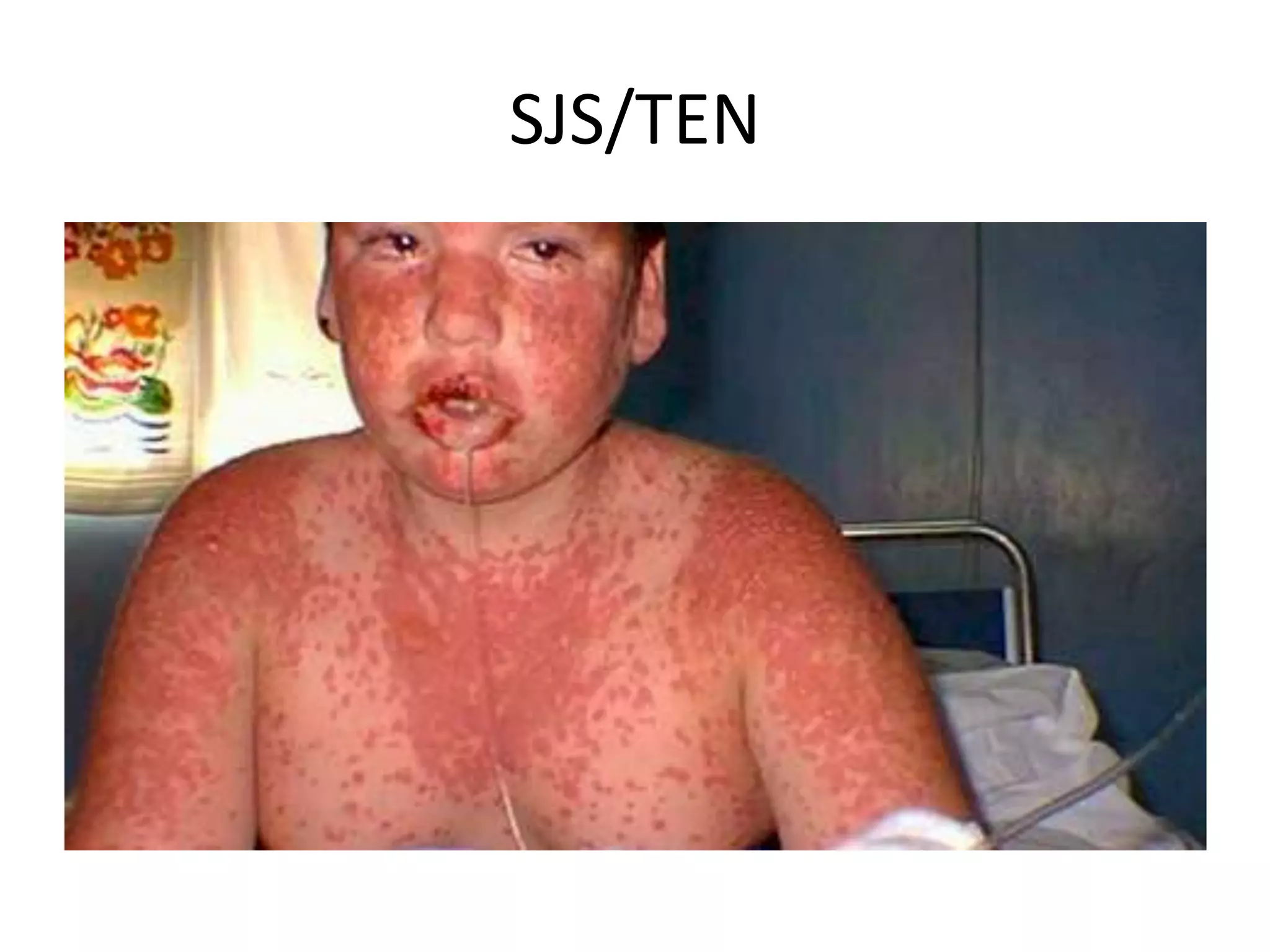 Pediatric rashes | PPTX
