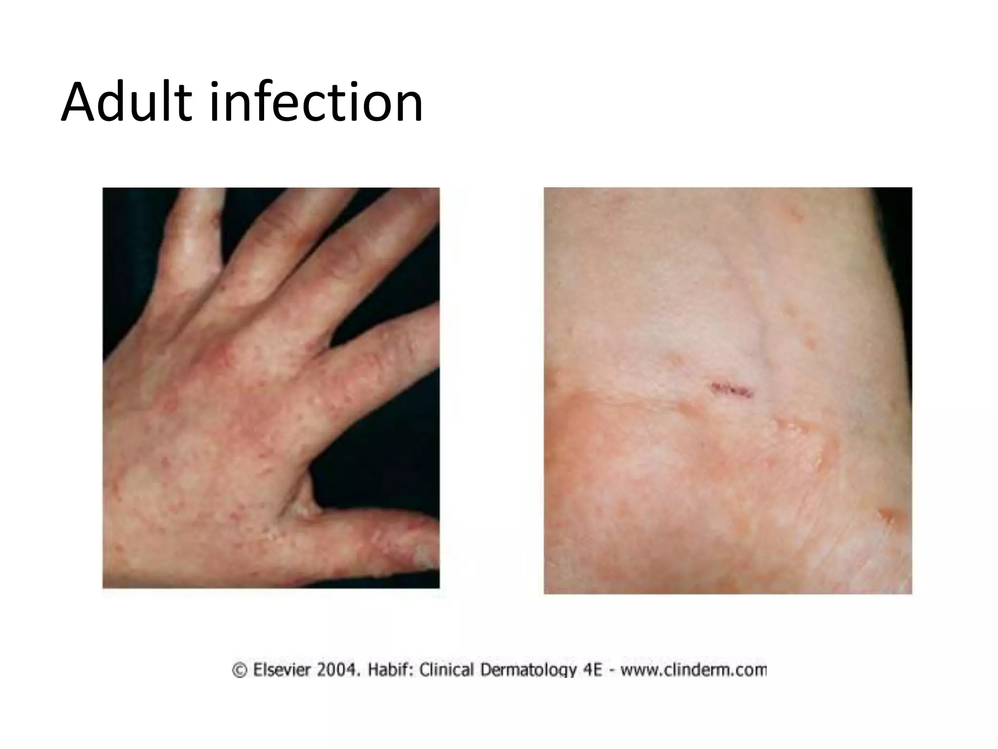 Pediatric rashes | PPTX