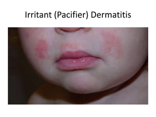 Pediatric rashes | PPT