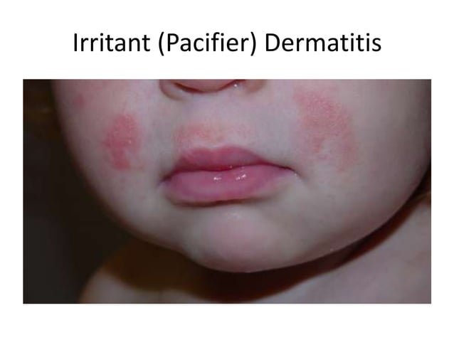 Pediatric rashes