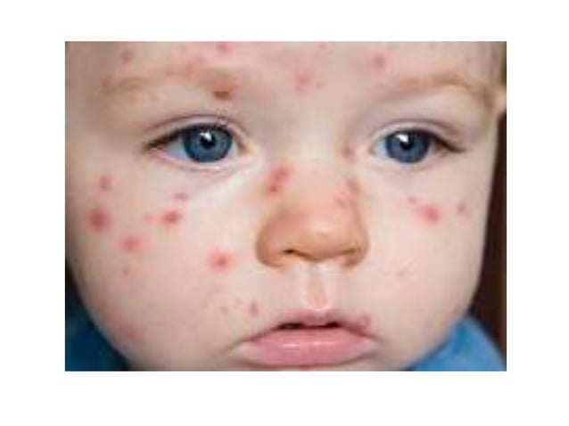 Pediatric rashes