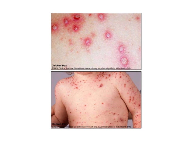 Pediatric rashes