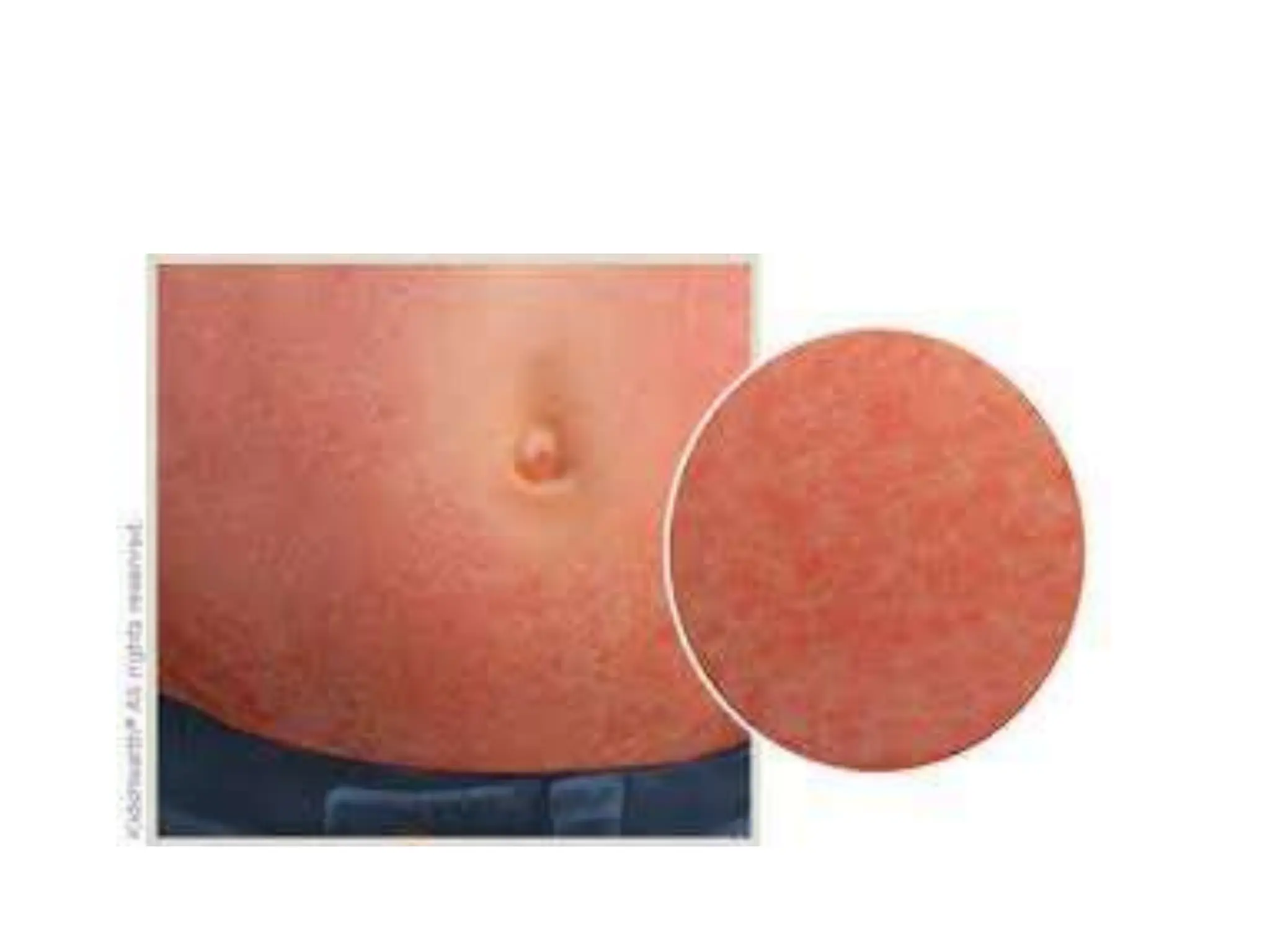 Pediatric Rashes.pptx