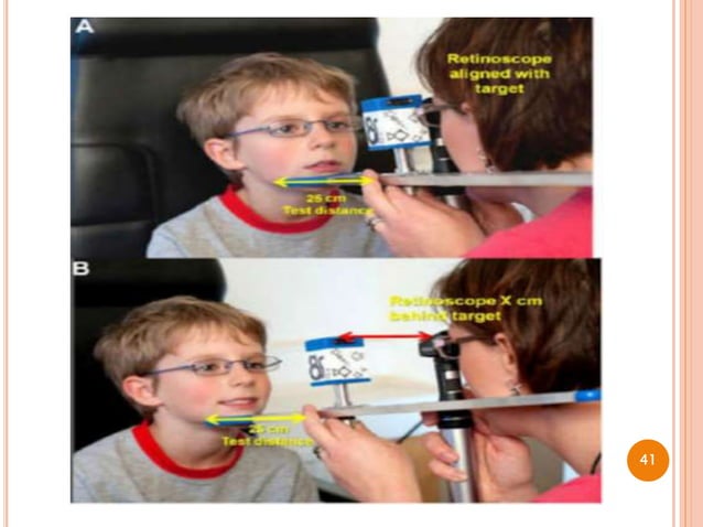Pediatric refraction | PPTX