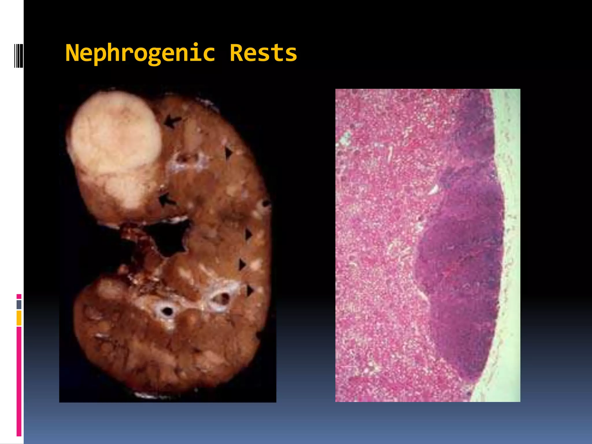 Pediatric renal tumors radiology | PPTX