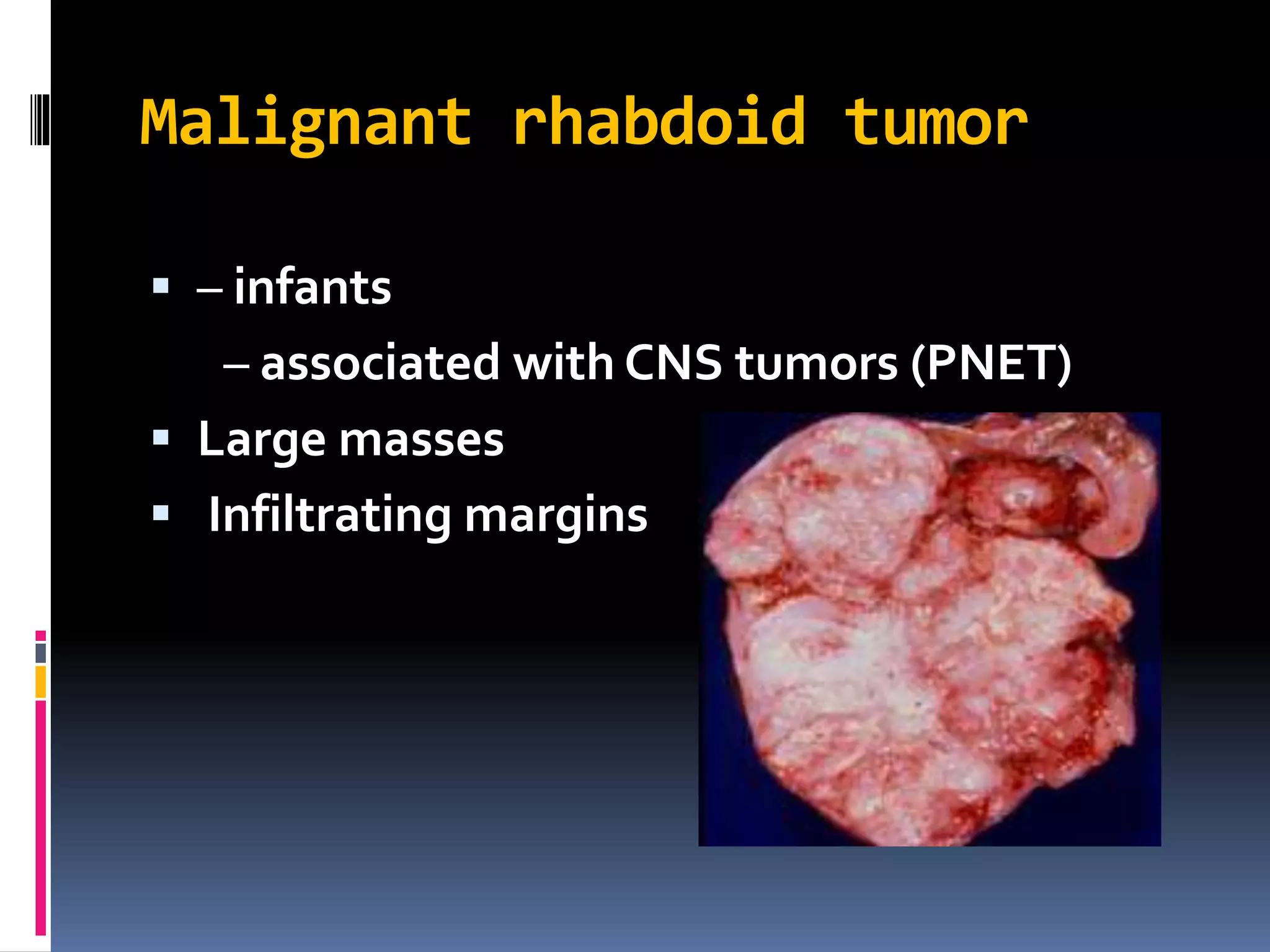Pediatric renal tumors radiology | PPTX