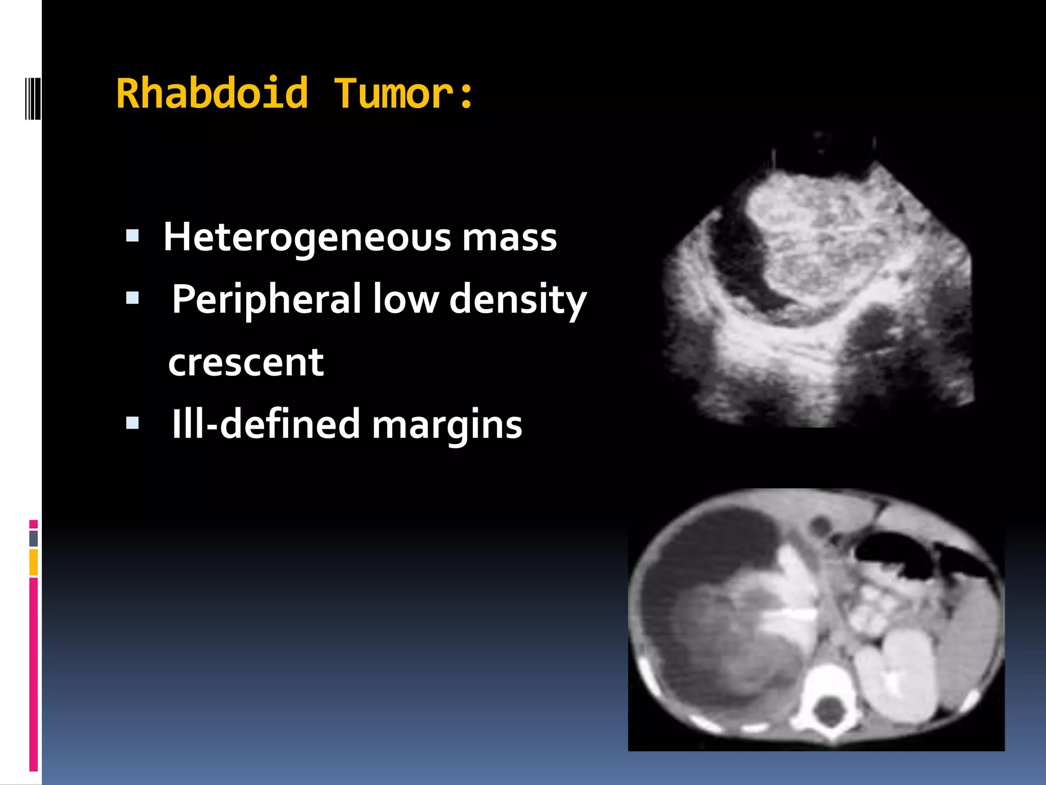 Pediatric renal tumors radiology | PPTX