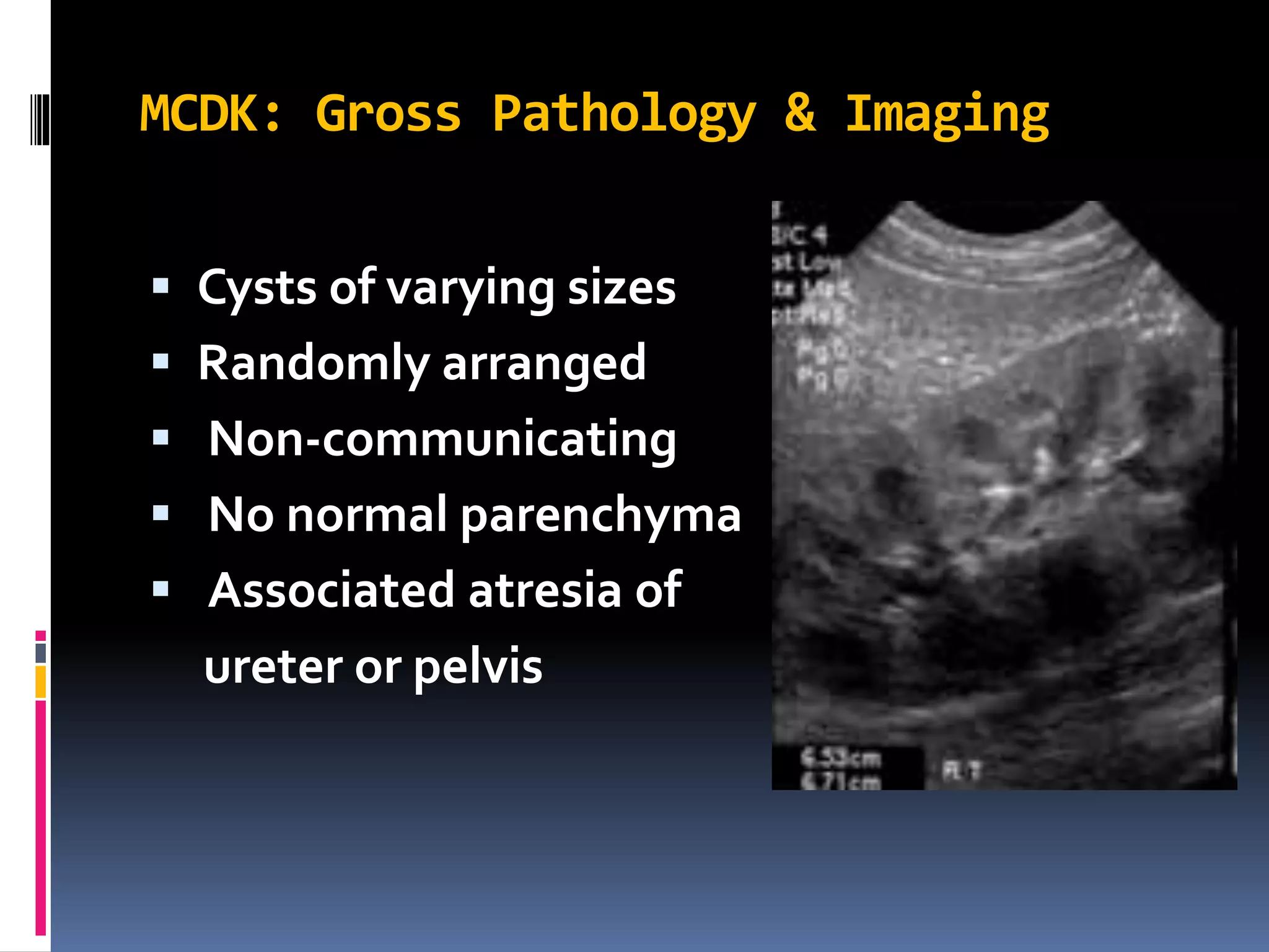Pediatric renal tumors radiology | PPTX