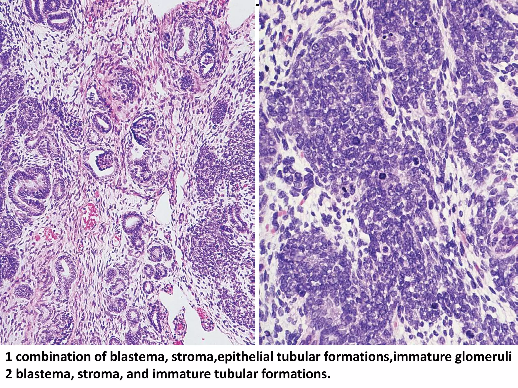 Pediatric Renal Tumors | PPTX