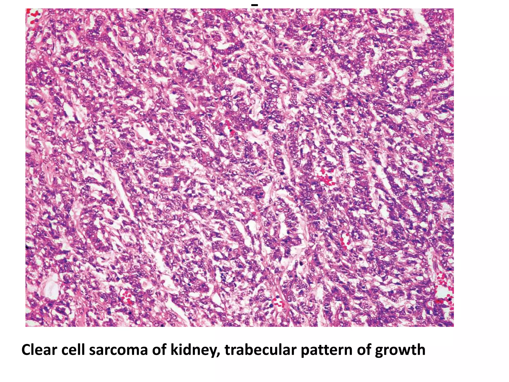 Pediatric Renal Tumors | PPTX