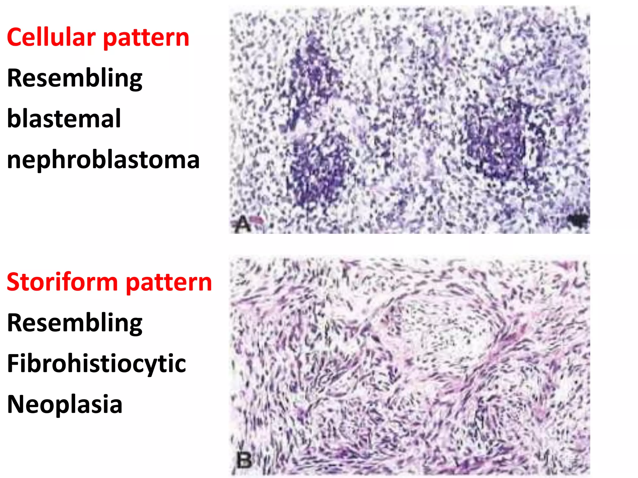 Pediatric Renal Tumors | PPTX