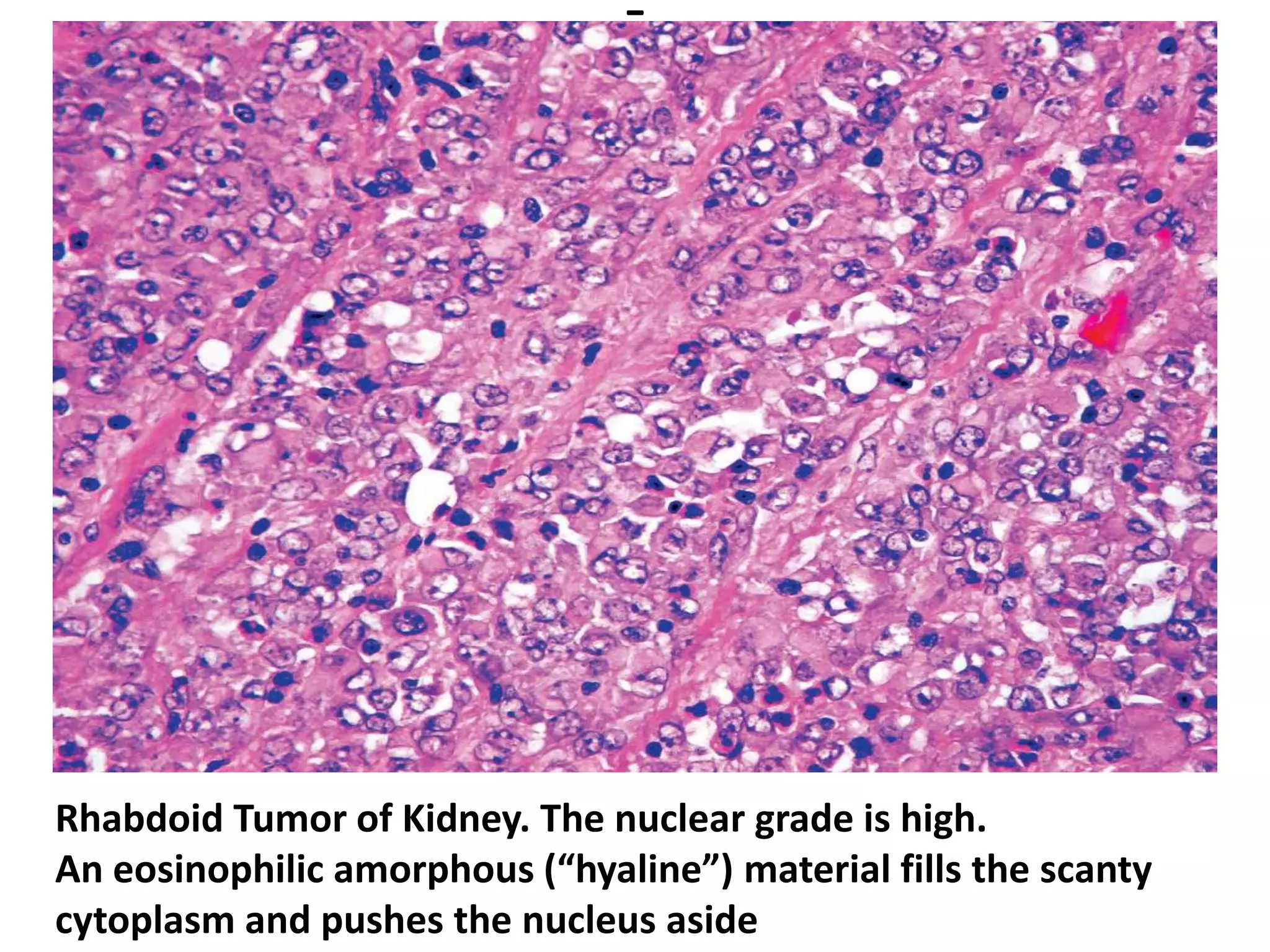 Pediatric Renal Tumors | PPTX