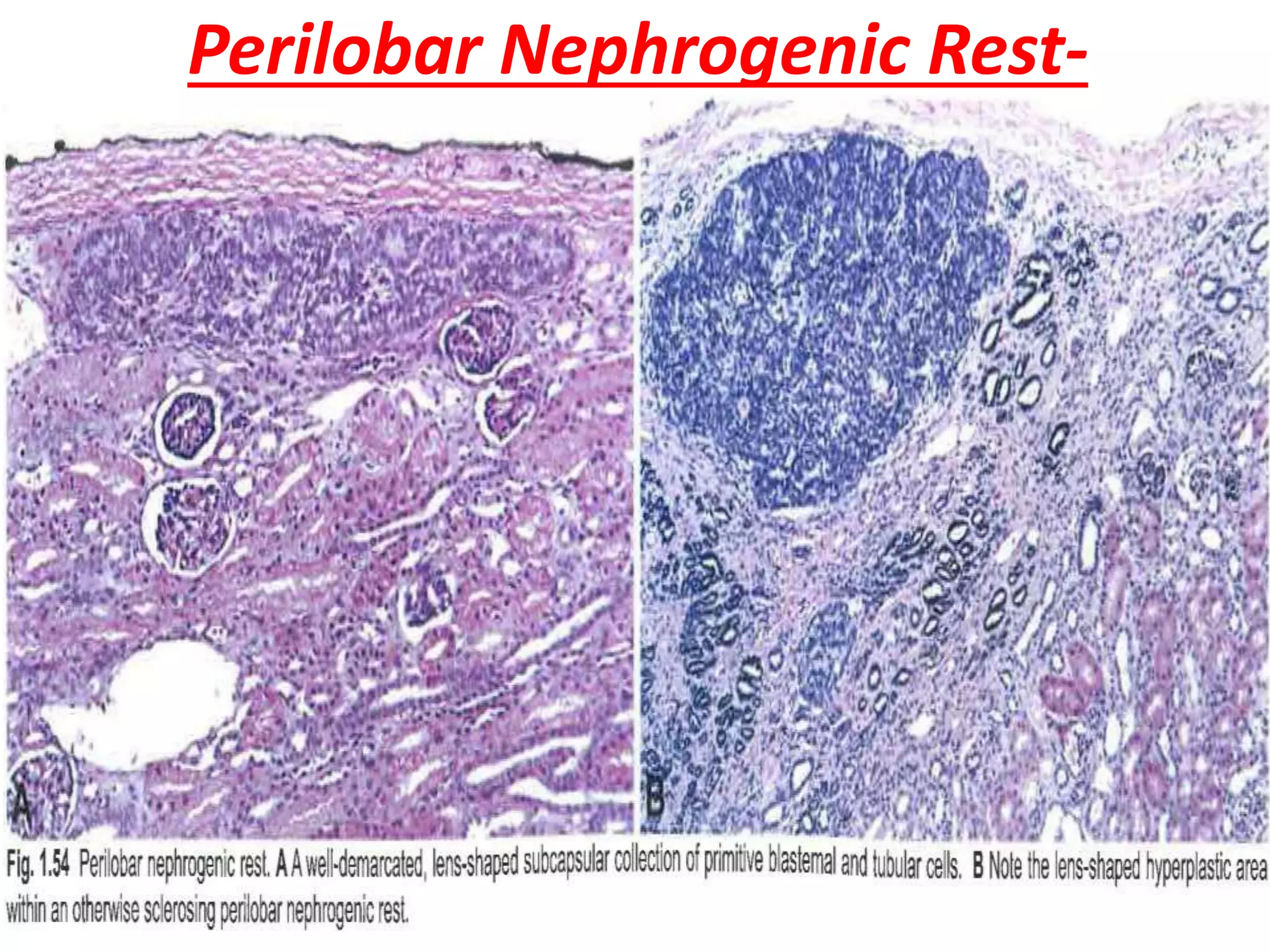 Pediatric Renal Tumors | PPTX