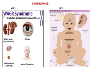 Pediatric renal tumors copy | PPT
