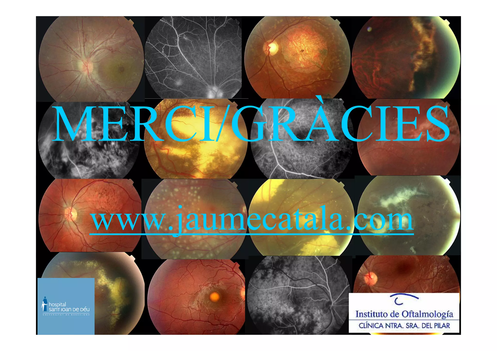Pediatric retinal detachment | PDF