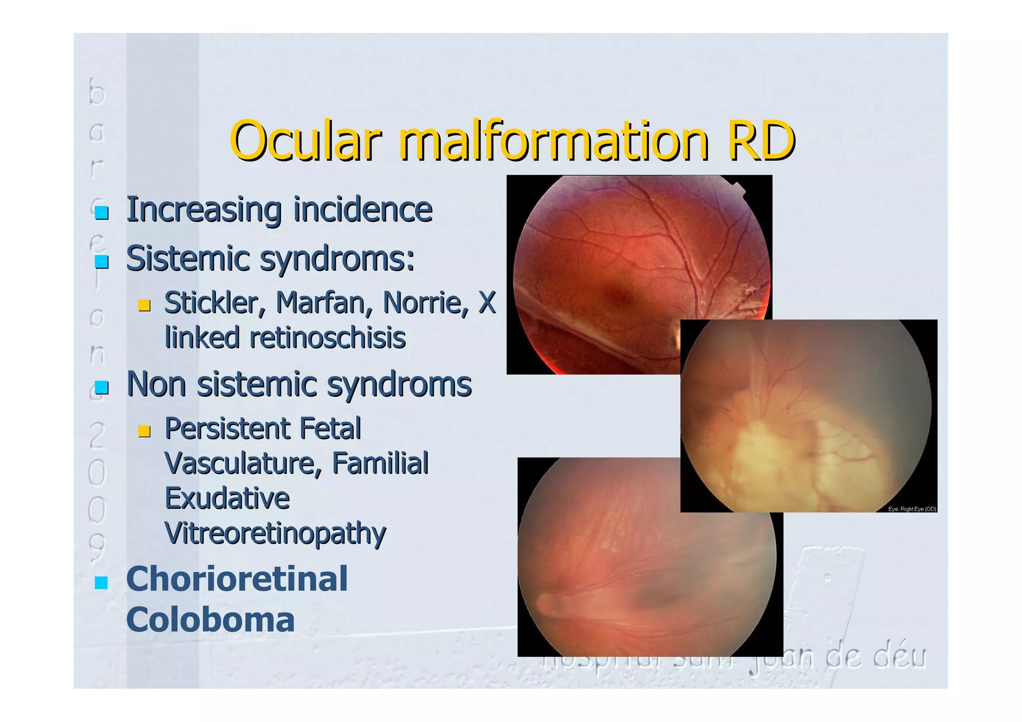 Pediatric retinal detachment | PDF