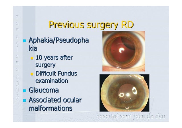 Pediatric retinal detachment | PDF