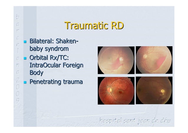 Pediatric retinal detachment | PDF