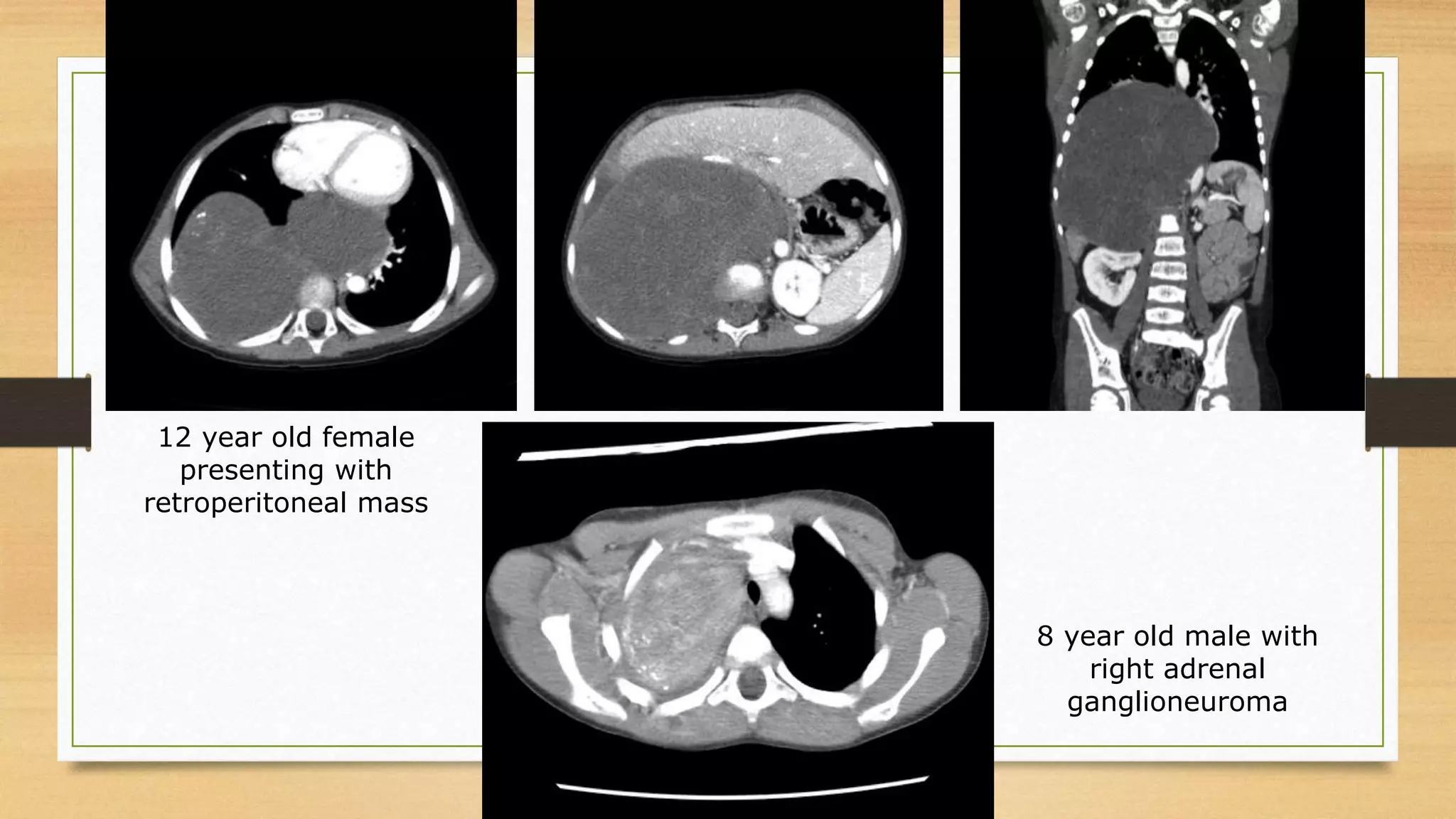 Imaging in Pediatric Retroperitoneal Masses | PPTX