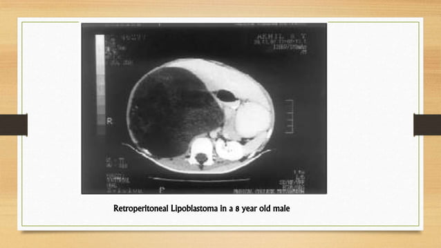Imaging in Pediatric Retroperitoneal Masses | PPTX | Medical Health