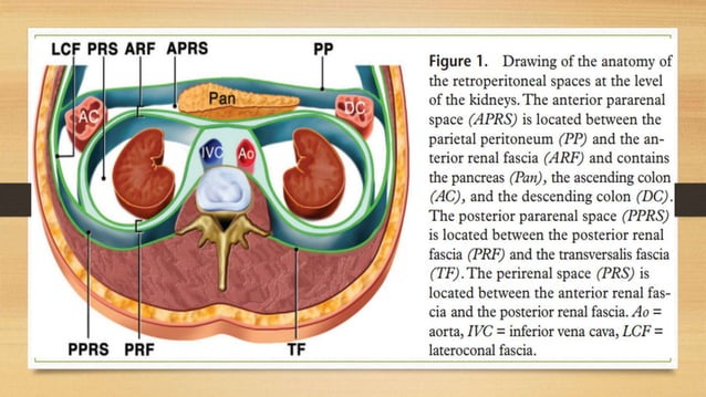 Imaging in Pediatric Retroperitoneal Masses | PPT