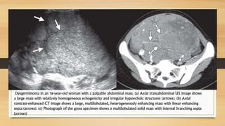 Imaging in Pediatric Retroperitoneal Masses | PPTX | Medical Health