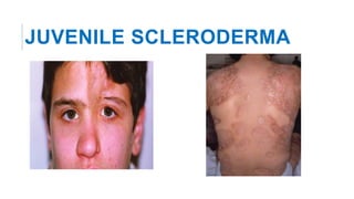 Pediatric Rheumatic Diseases by JJ Laspoñas | PPTX