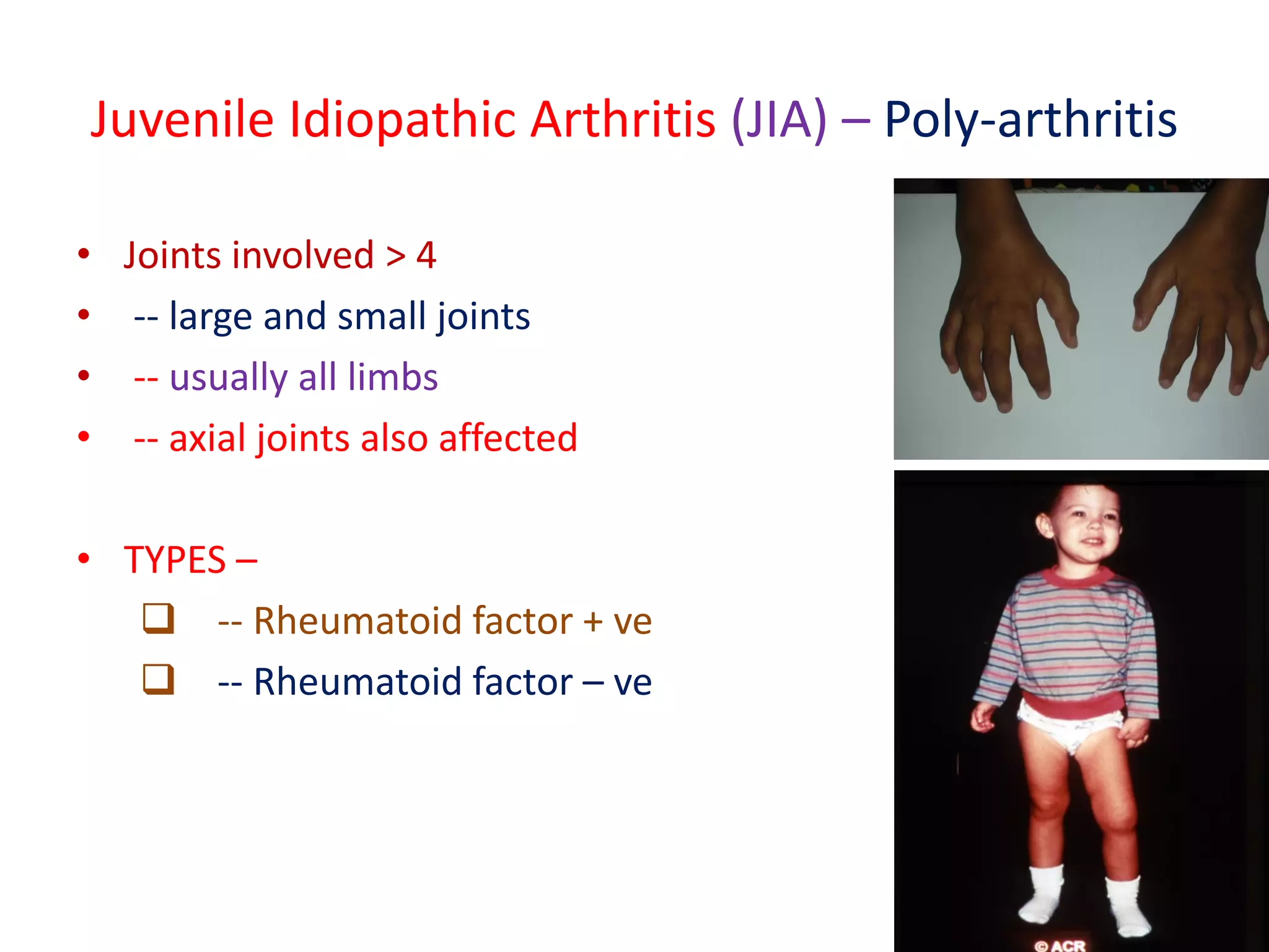 Pediatric rheumatology 2021 | PDF