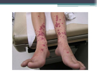 Bleeding neonate / child | PPTX