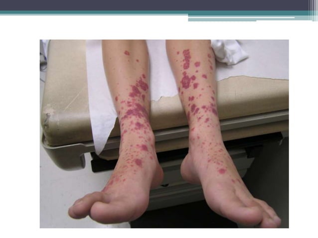 Bleeding neonate / child | PPTX | Blood Disorders | Diseases and Conditions