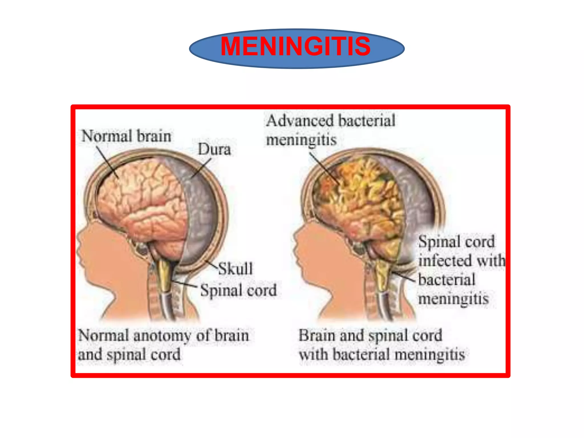 Review of Meningitis | PPTX