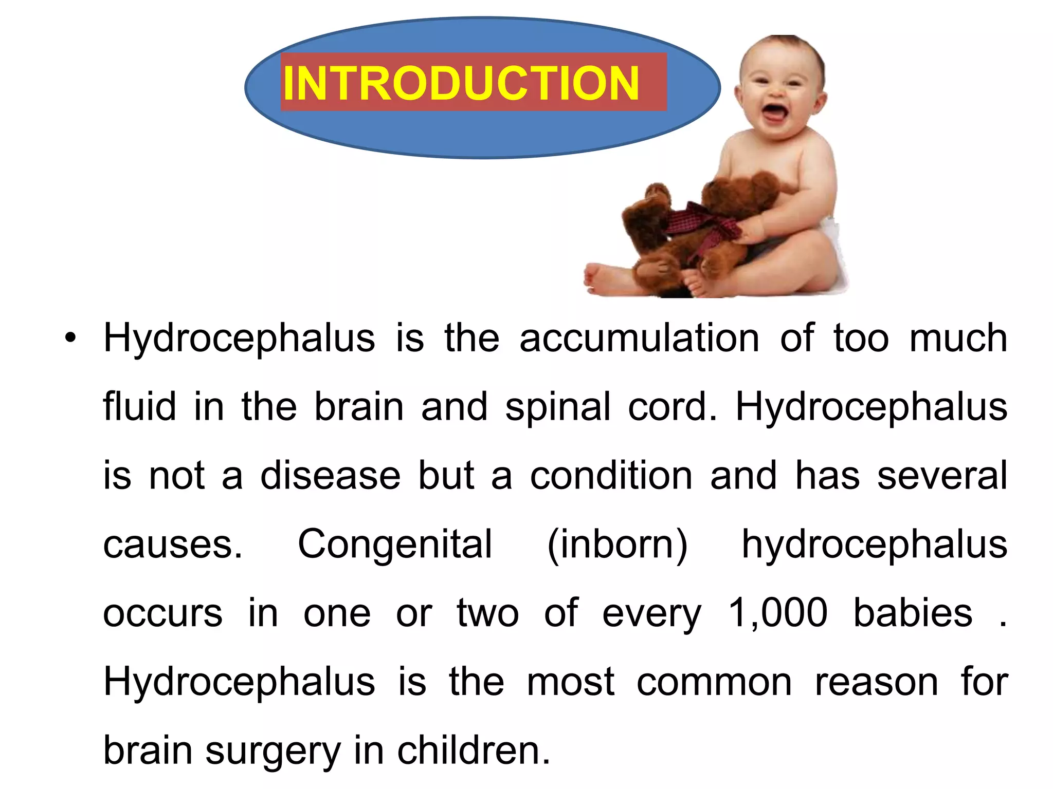 Review of Hydrocephalus | PPTX