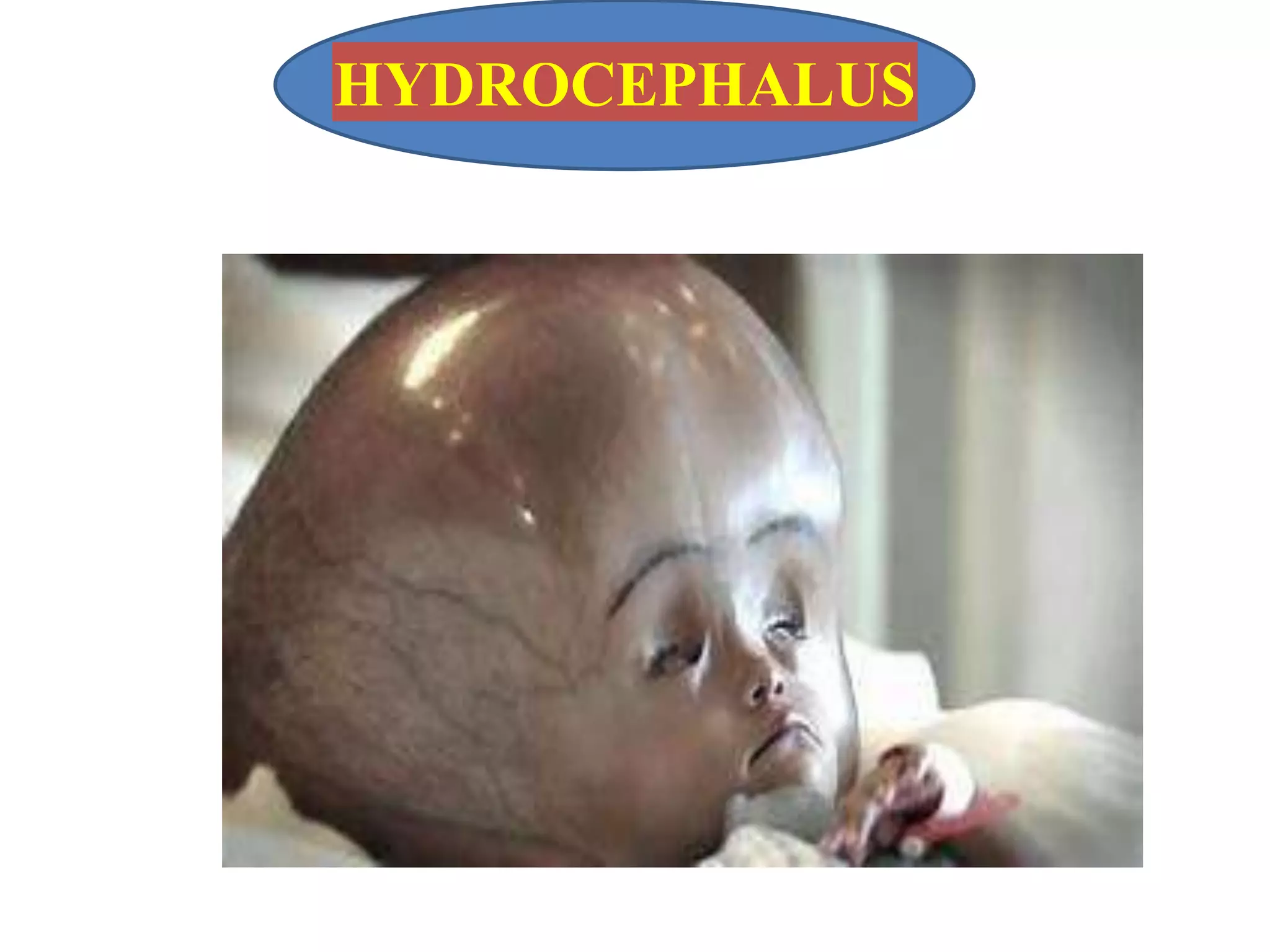 Review of Hydrocephalus | PPTX