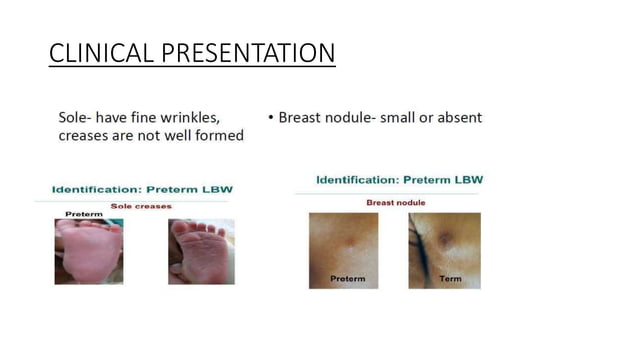complications of preterm birth pediatrics 2.pptx