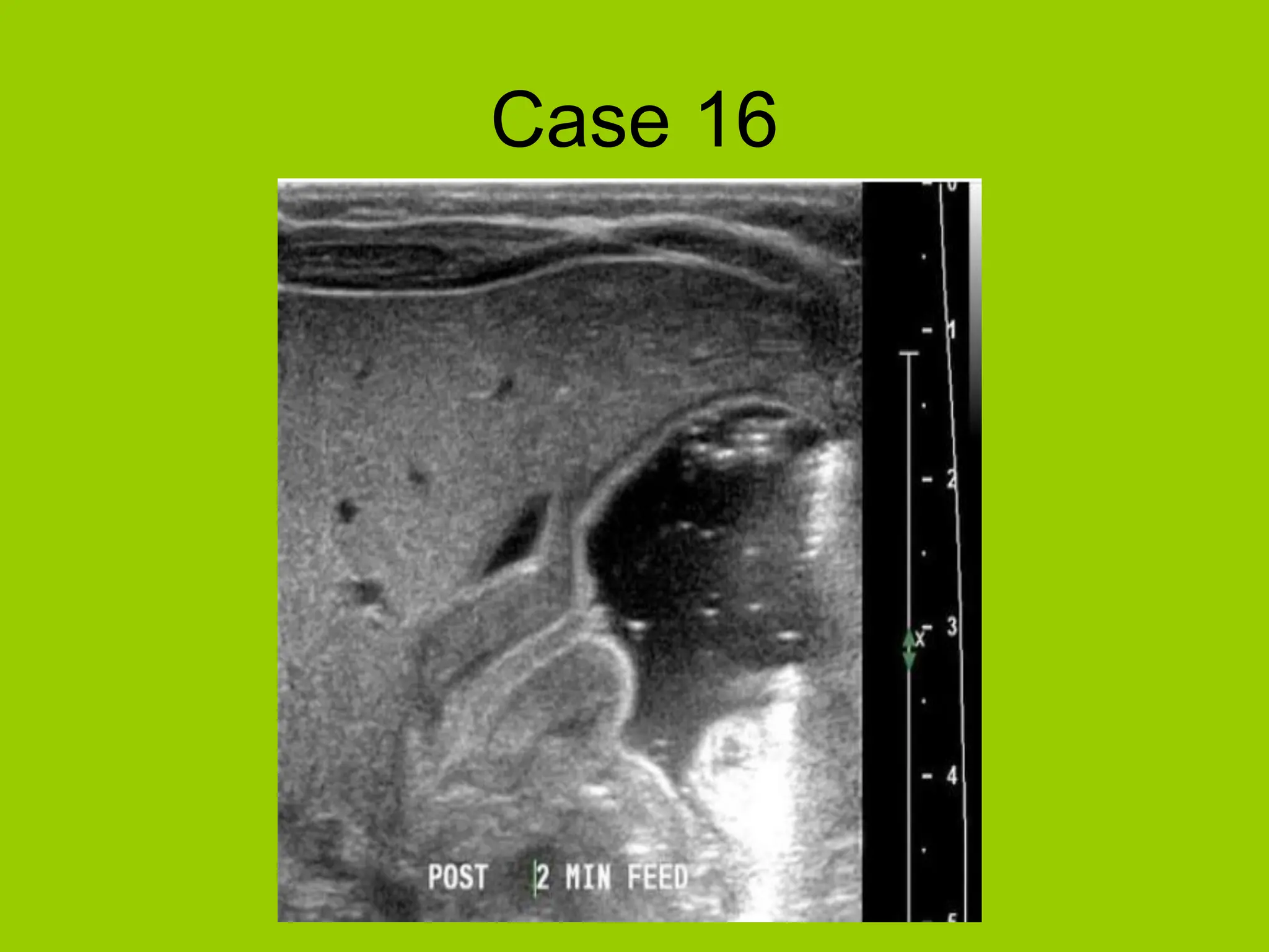 Pediatrics, Barium and Urological contrast technique Revision cases.pdf