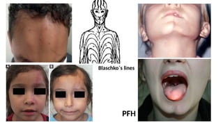 Pediatric scleroderma how to diagnosis .pptx