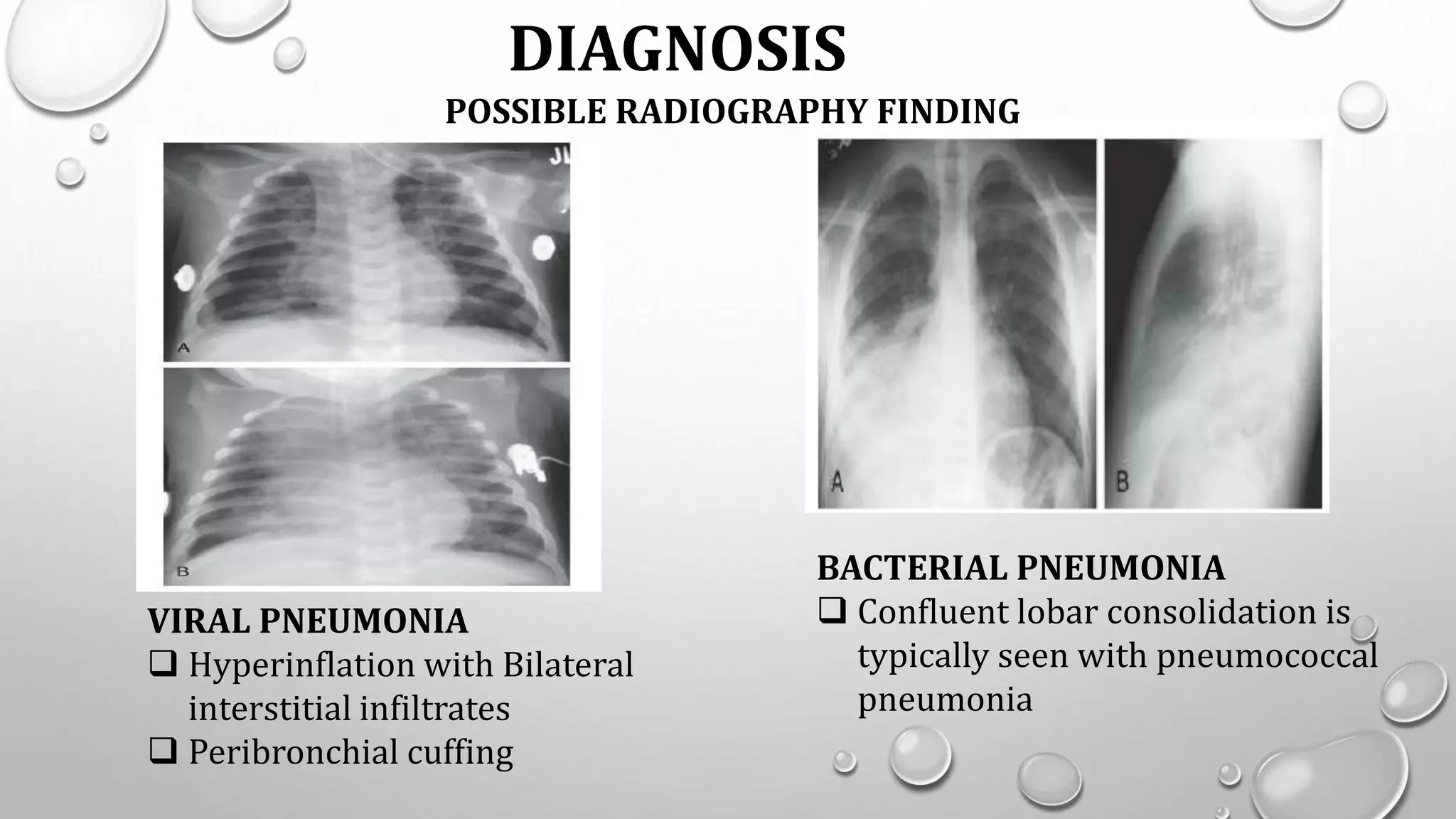 Pediatrics Community Acquired Pneumonia case study.pptx
