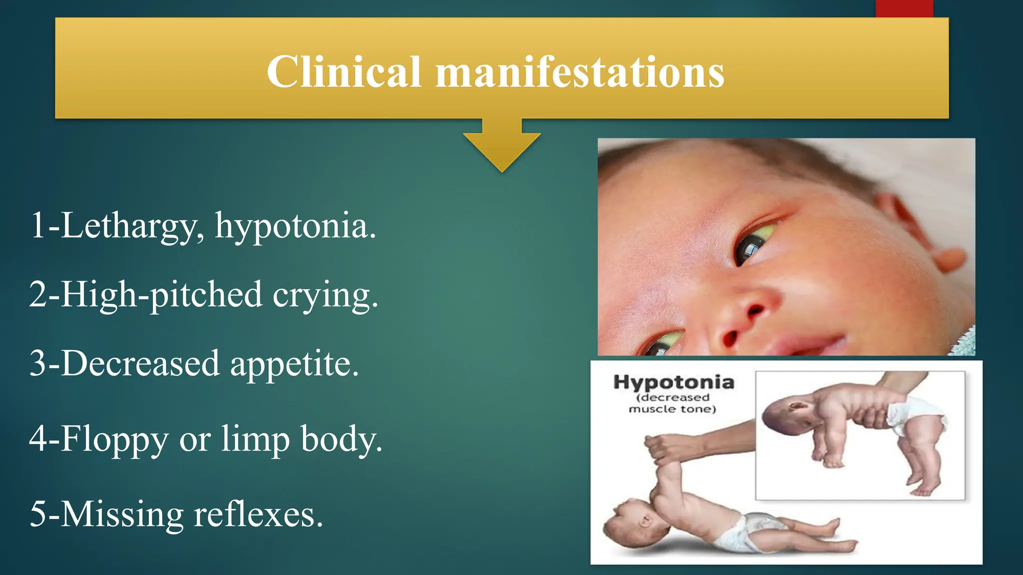 Pediatric seminar (Kernicterus).pptx....... | PPTX