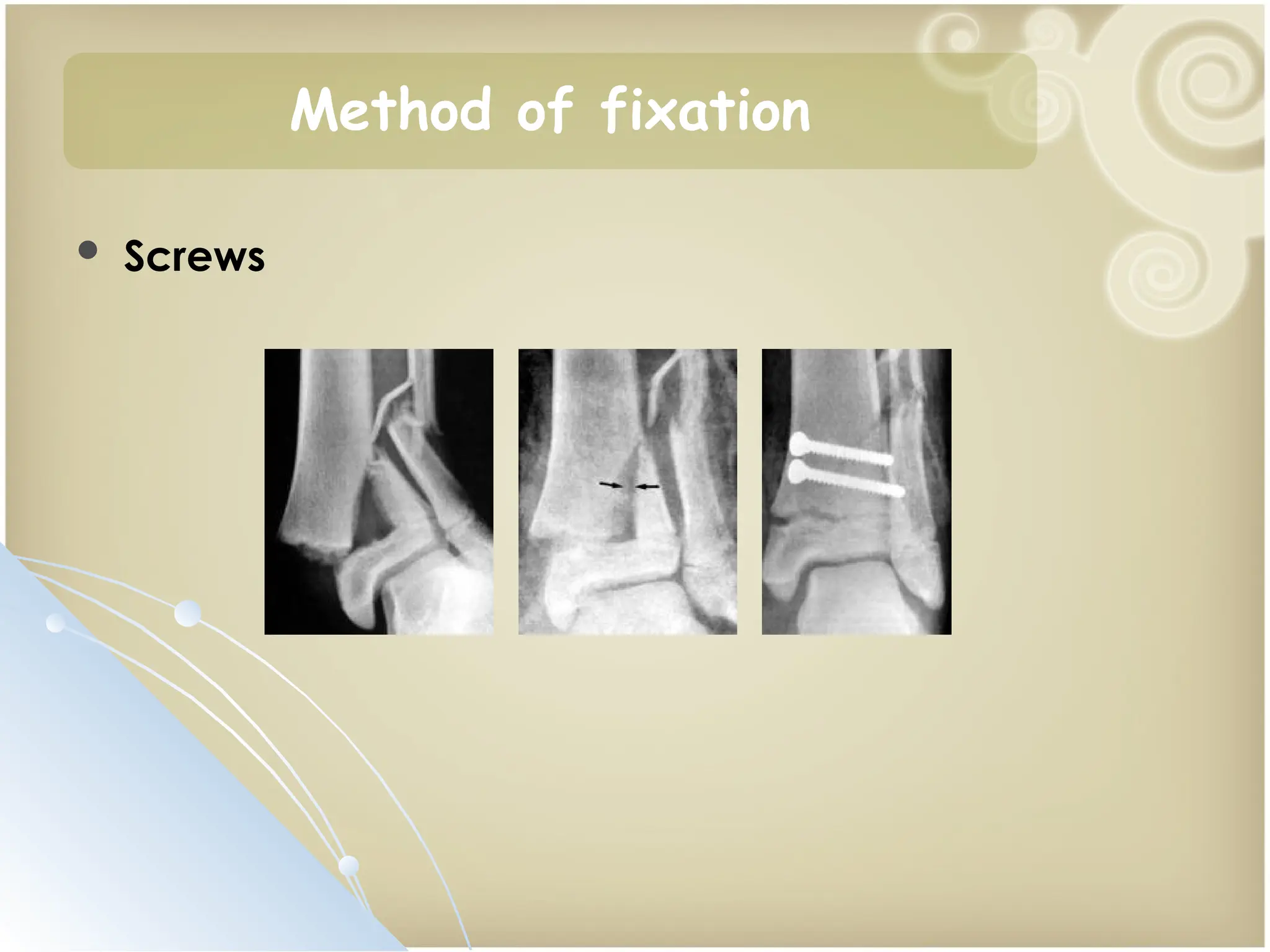 PEDIATRICS FRACTURES IN CHIDLRENS ORTHO.pptx