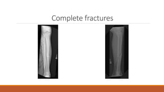 PEDIATRIC SHAFT FRACTURE MANAGEMENT1.pptx