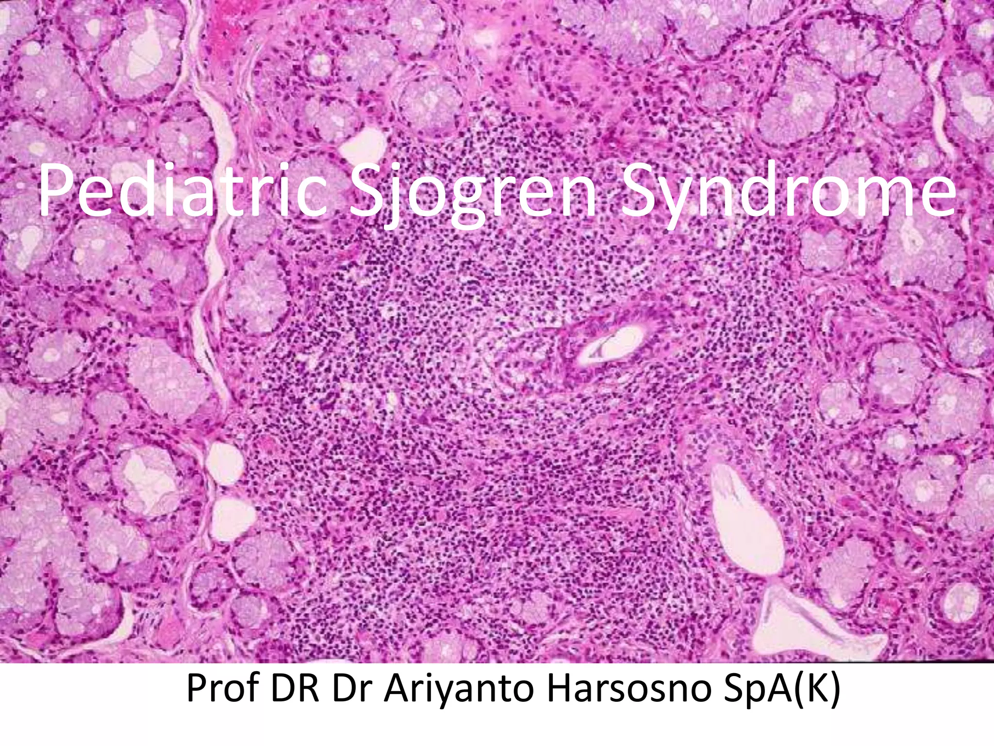 Pediatric Sjogren syndrome | PPTX