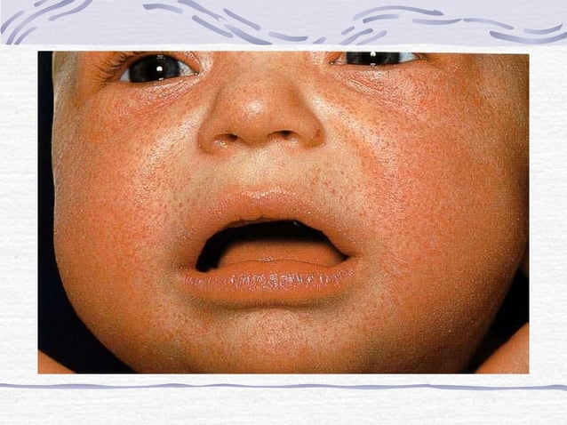 Pediatric skin & soft tissue conditions dr n.s.ramburn | PPT